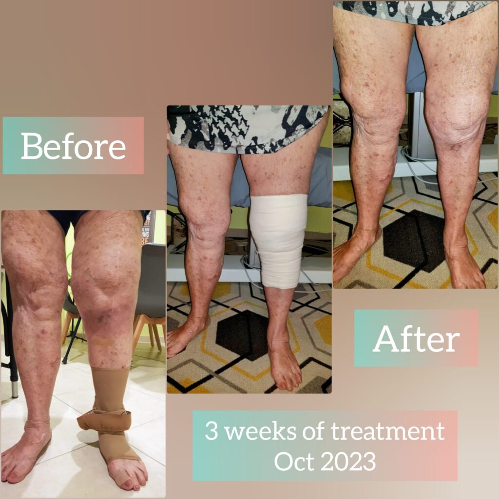 Manual Lymphatic Drainage (MLD) – ARC